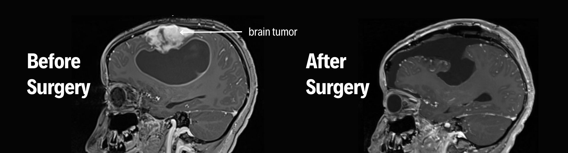 Brain Tumors in Children: Types, Causes, Symptoms & Treatment - ACIBADEM
